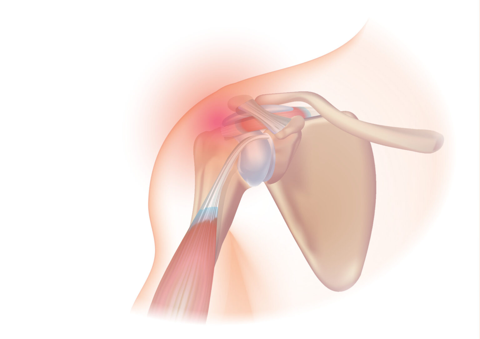 Rotator Cuff Muscle Related Issues and Shoulder Impingement – Bild Clinic